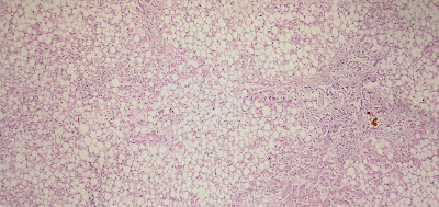 Steatosis Hepatis | Pathology