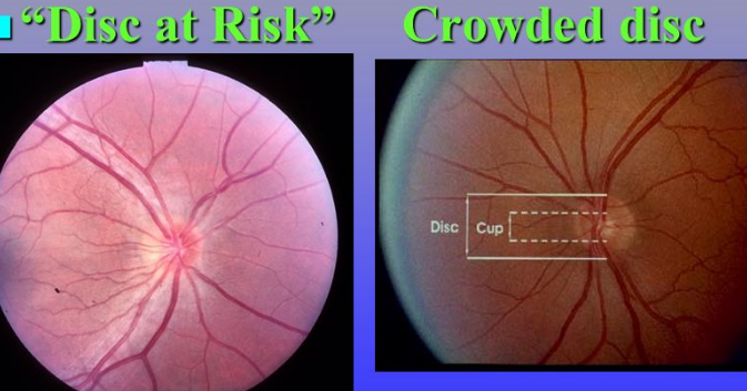 Sandra Lora Cremers MD, FACS: DISC AT RISK: What you need to know if ...