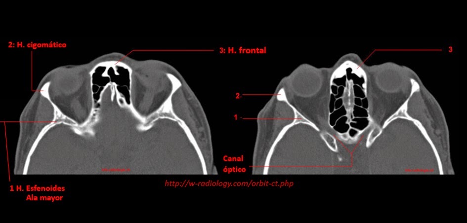 Anatomía y patologías de la cavidad orbitaria | ESPE 202 - 2014