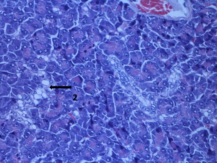 Diabetes Mellitus: Histopathology