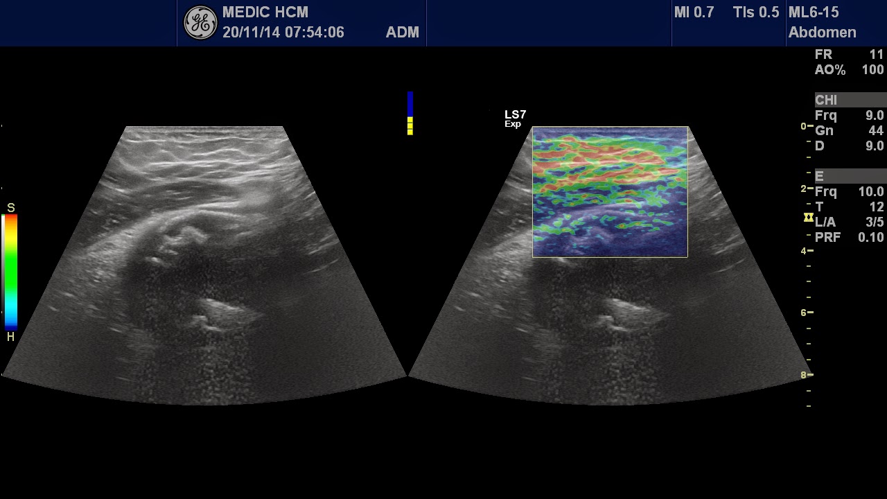 VIETNAMESE MEDIC ULTRASOUND: CASE 282: SUPRAPUBIC MASS, Dr PHAN THANH ...