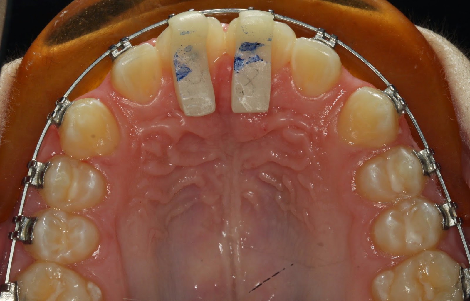 Orthodontic Thoughts: One Easy Way to Reduce Treatment Time and Broken ...