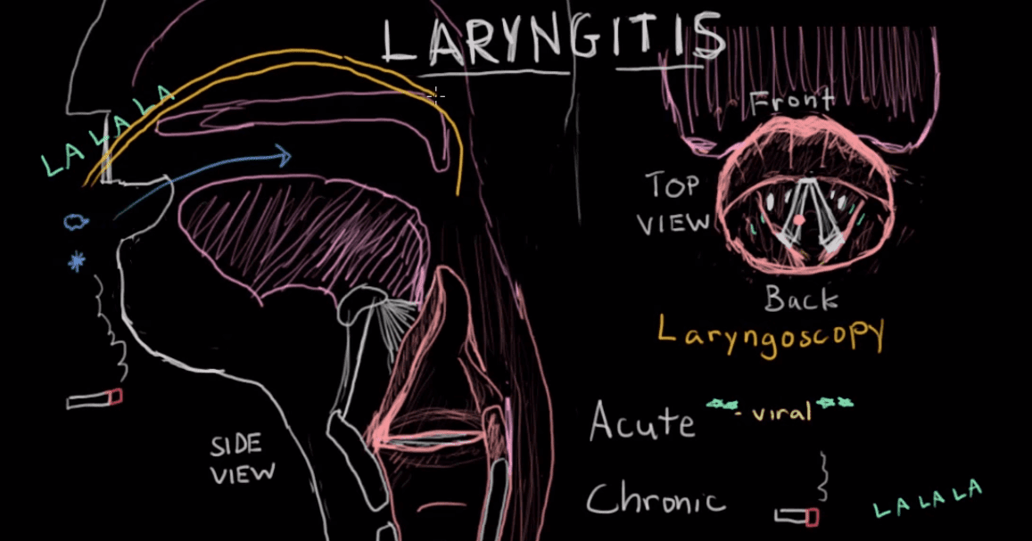 Chronic Laryngitis: types, causes, symtpms, signs, treatment