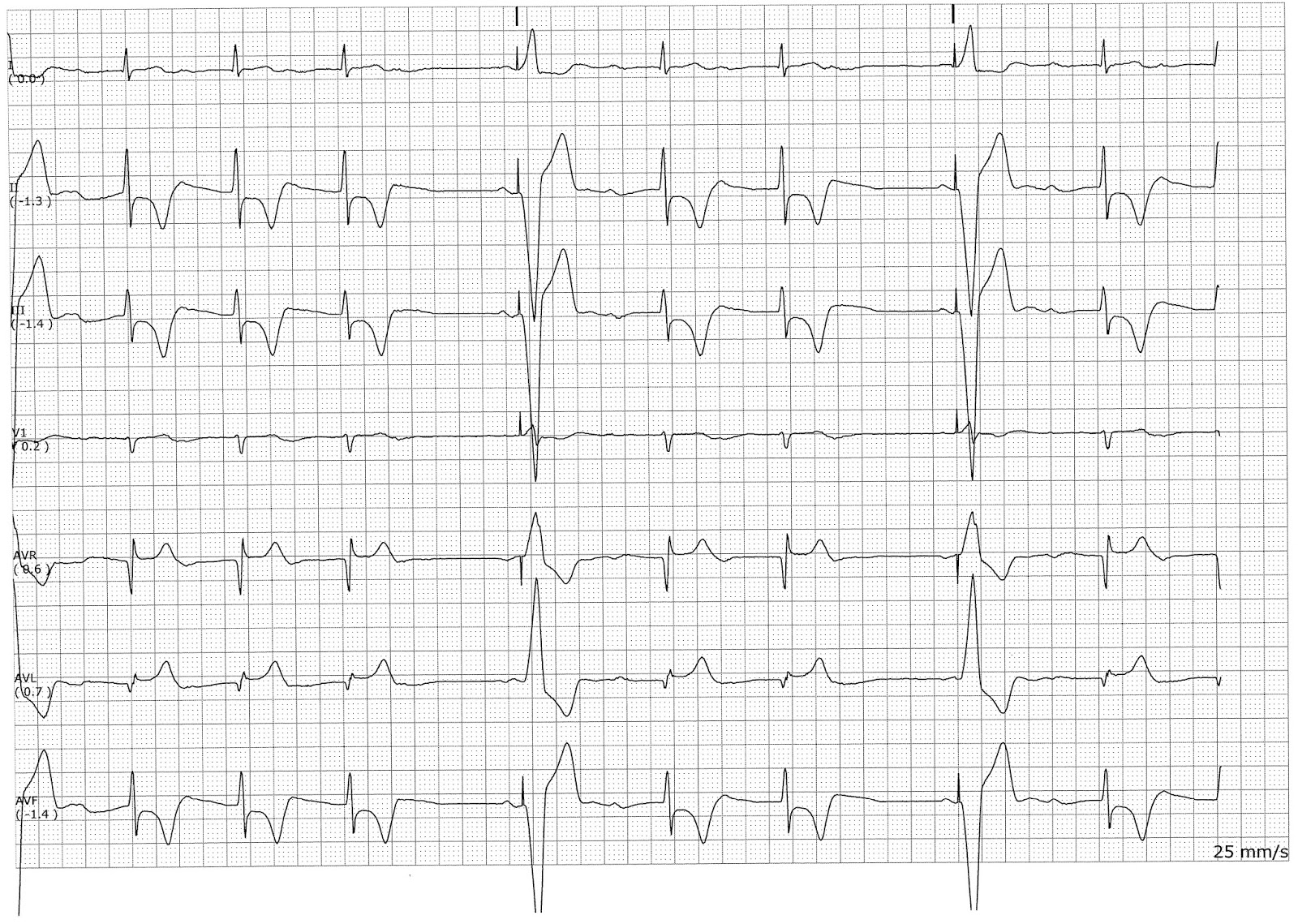 Demand ventricular pacing