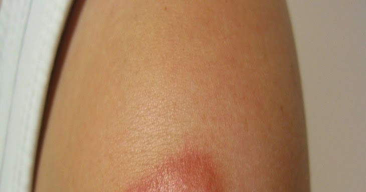 How To Get Rid Of Keloids | Tips Park