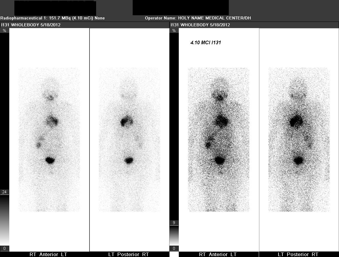Nuclear Medicine Technology Program: Abnormal I-131 case study