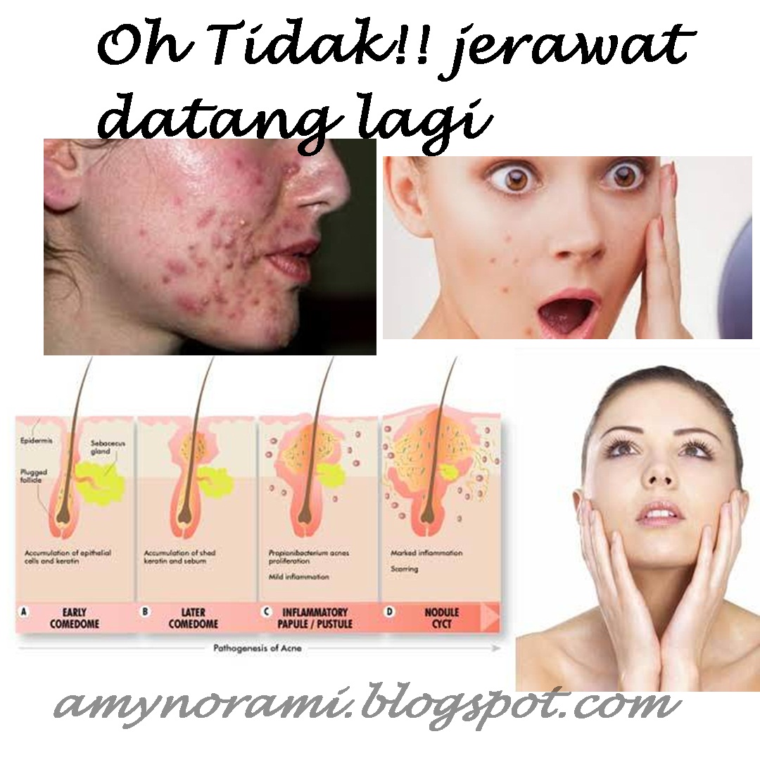 MASALAH KULIT MUKA : Punca Kulit Berjerawat Dan Cara Mengatasinya - amynorami.com