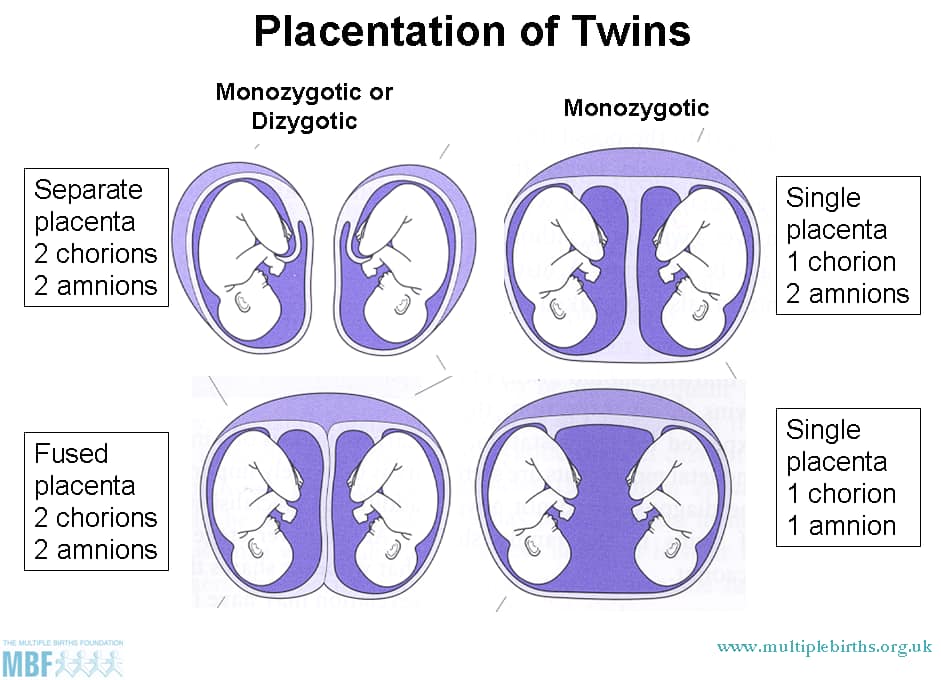 Apa Yang Perlu Difahami Tentang TWIN TO TWIN TRANSFUSION SYNDROME (TTTS ...