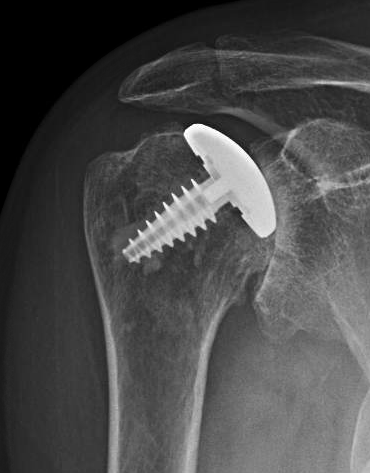 UW Shoulder and Elbow Academy: Is there an advantage in partial humeral ...