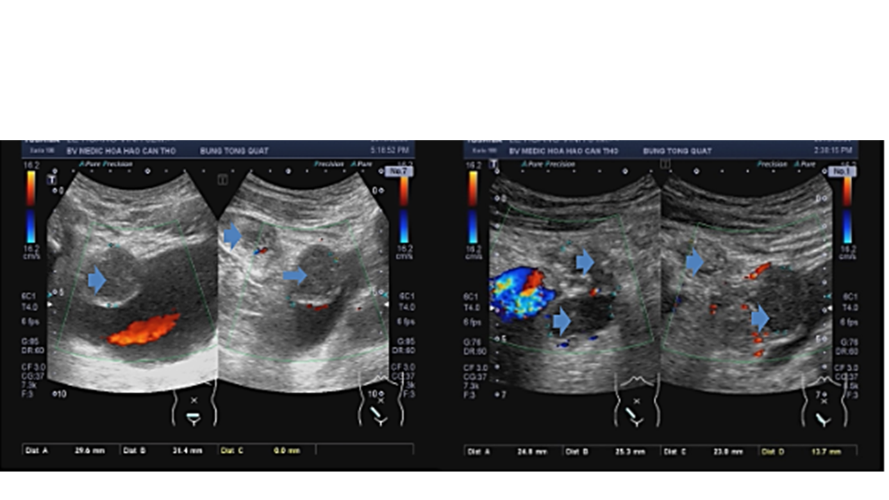 VIETNAMESE MEDIC ULTRASOUND: CASE 543: PELVIC WALL ABSCESS, Dr PHAN ...