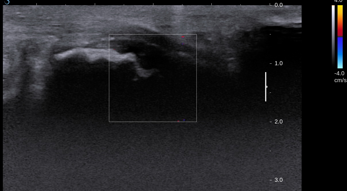 VIETNAMESE MEDIC ULTRASOUND: CASE 466:CHILDREN HEEL PAIN : A SEVER'S ...