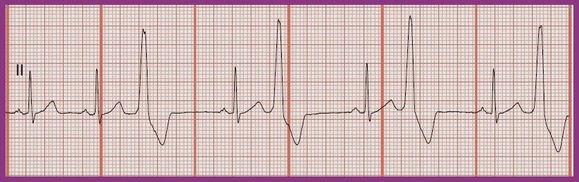 EKG Rhythm Strip Quiz 199
