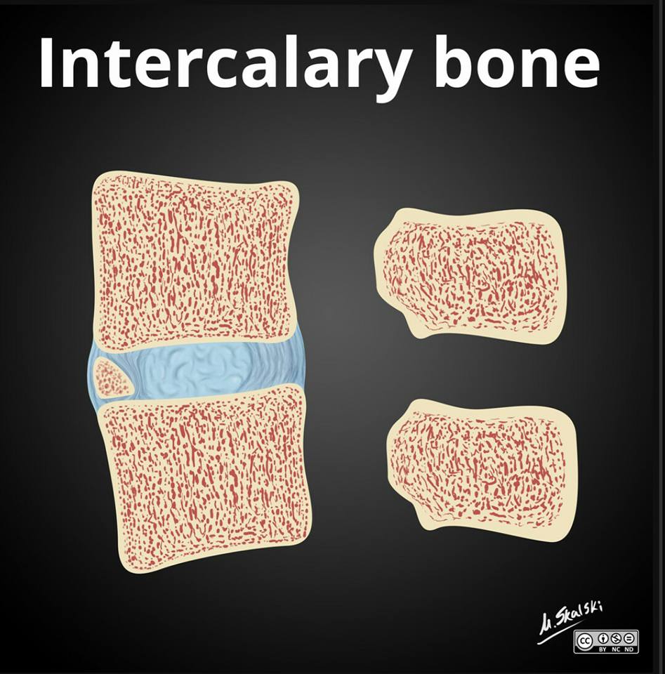 Limbus vertebrae | CĐHA | CHẨN ĐOÁN HÌNH ẢNH
