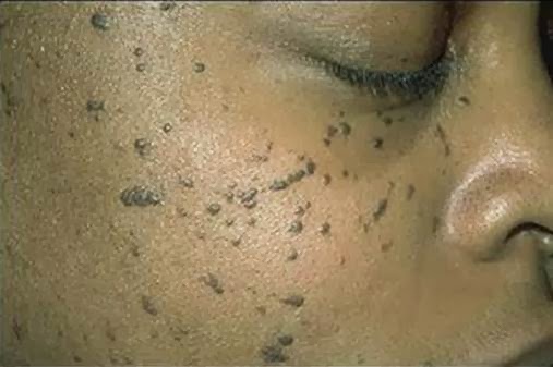 Skin Tags ? now you can get rid of them!