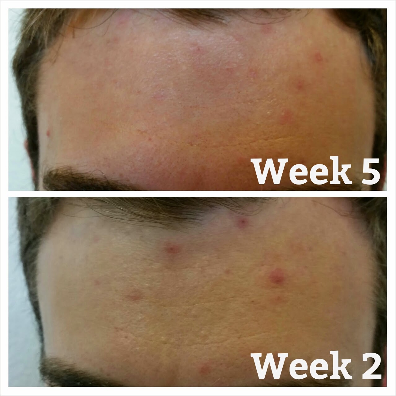 The Make-Up & Skin Care Studio: Controling Acne - Skin Accumax...a ...