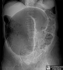 My Radiology World: Volvulus