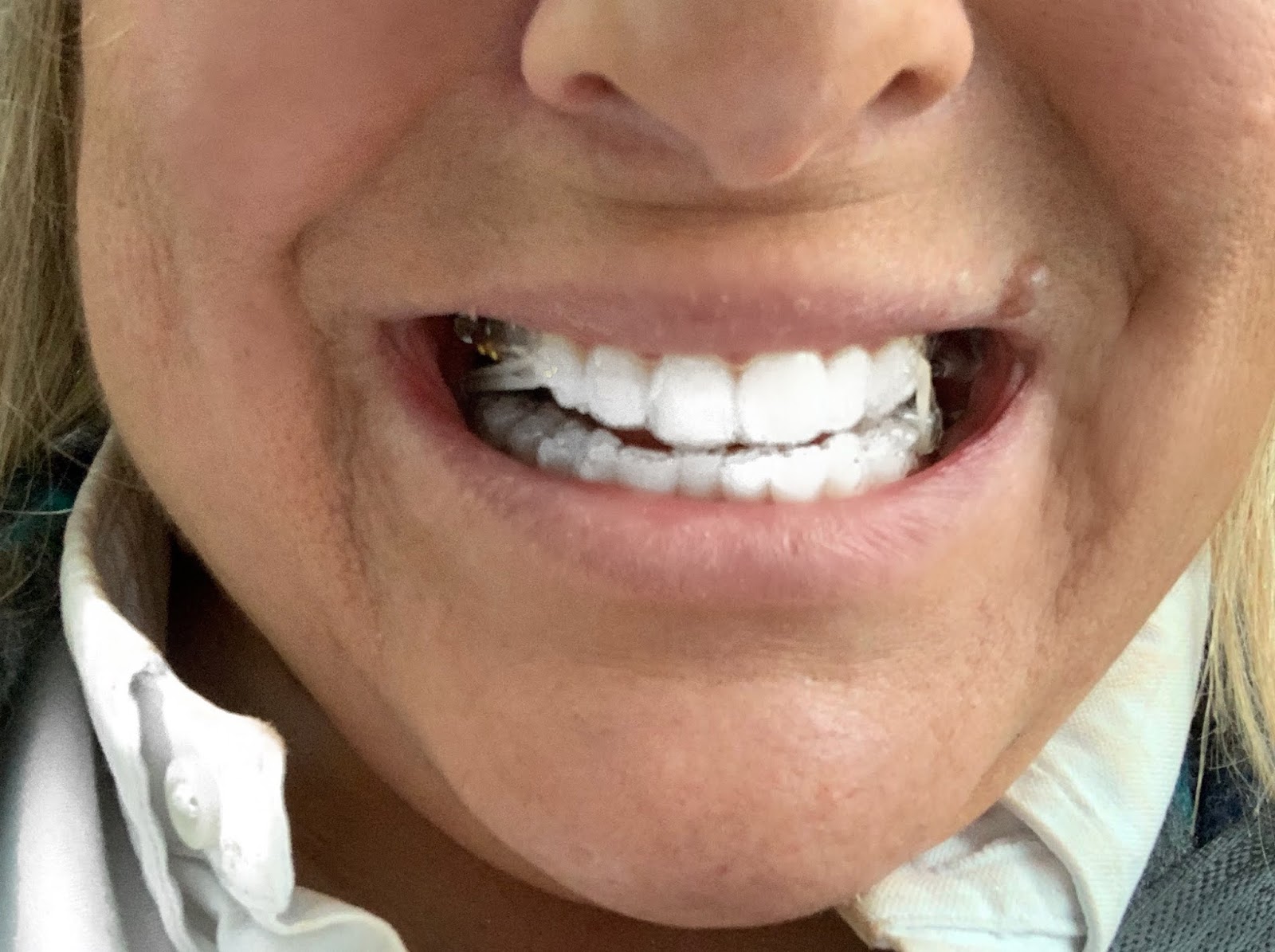 the happygirl: What it's like to get Invisalign