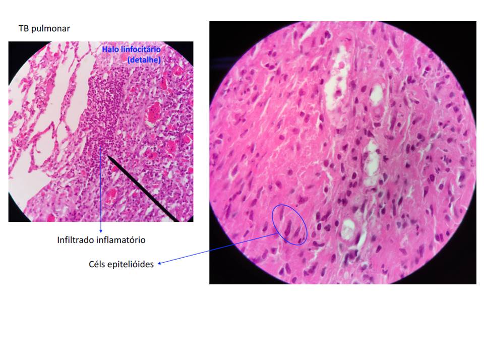 HISTOLOGIA90: TIPOS DE NECROSE