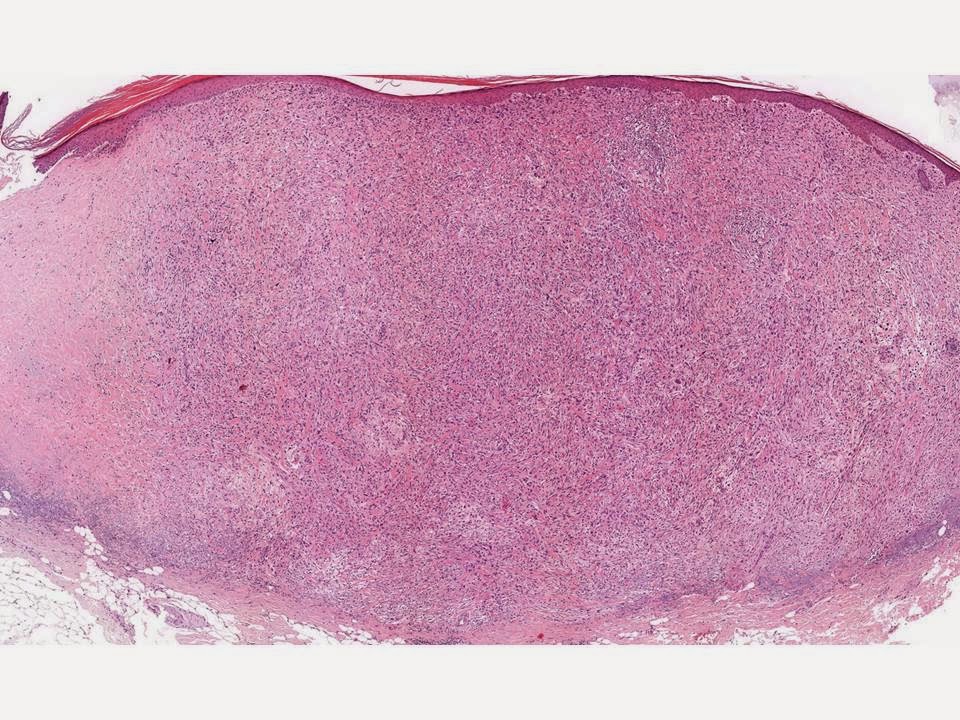 Dermpath Made Simple - Neoplastic: Atypical Fibroxanthoma