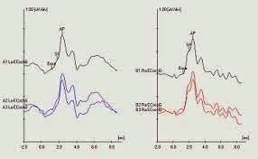 Your Audiology Tutorial: Electrocochleography (ECochG)