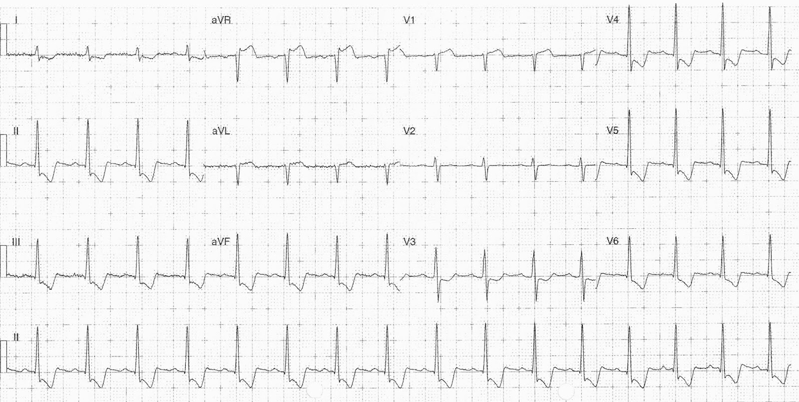 Interpretation Of The Normal Electrocardiogram Thoracic Key