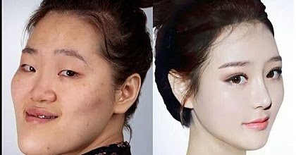 [Pann] Extreme plastic surgery success case