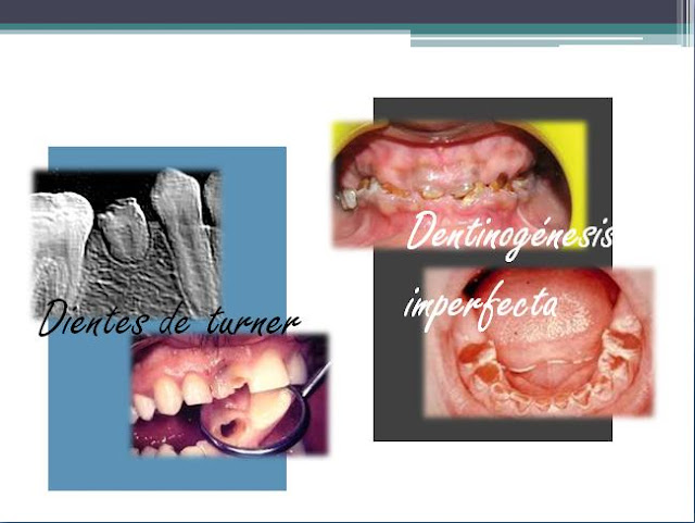 DENTAL 1001 UNAM: Macro y Microdoncia, y otras Anomalías Dentales ...