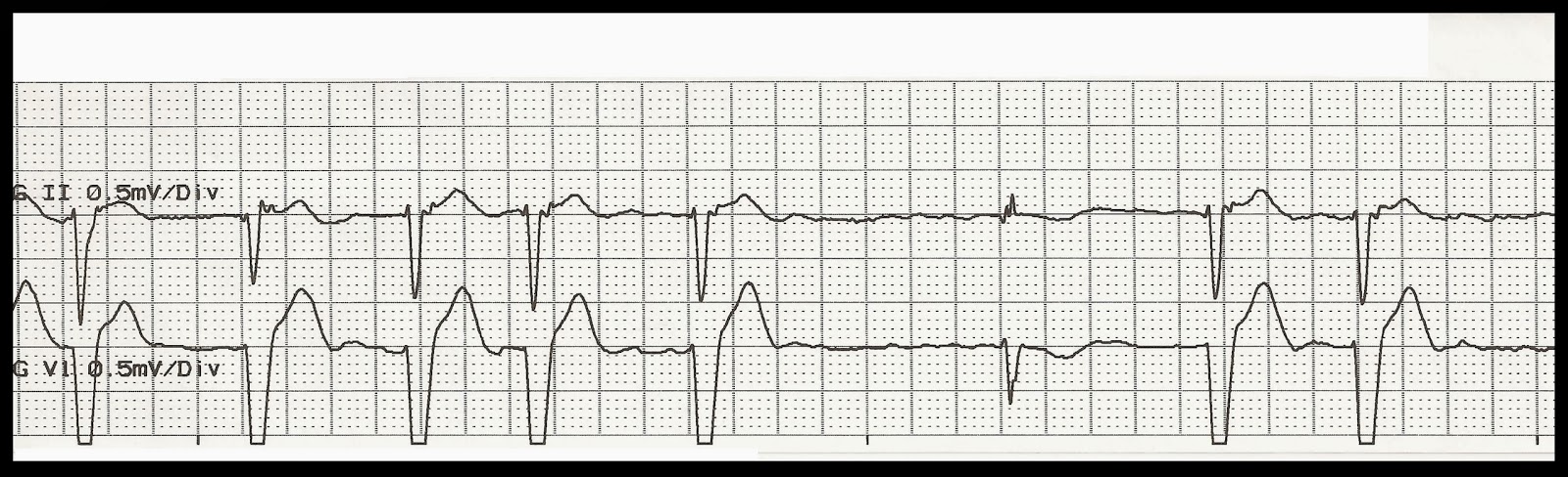EKG Rhythm Strip Quiz 181
