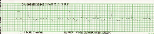 EKG Rhythm Strips 16: Atrial Rhythms