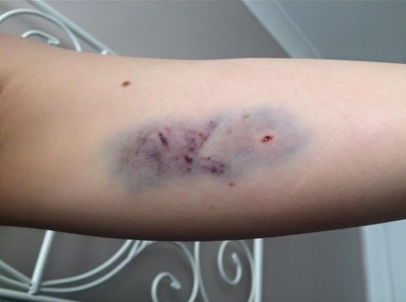 Moms Talk: KB Implant/Susuk (Implant Birth Control) - Review Pemakaian ...