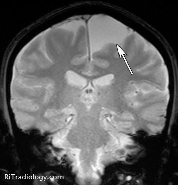 RiT radiology: Arachnoid Cyst