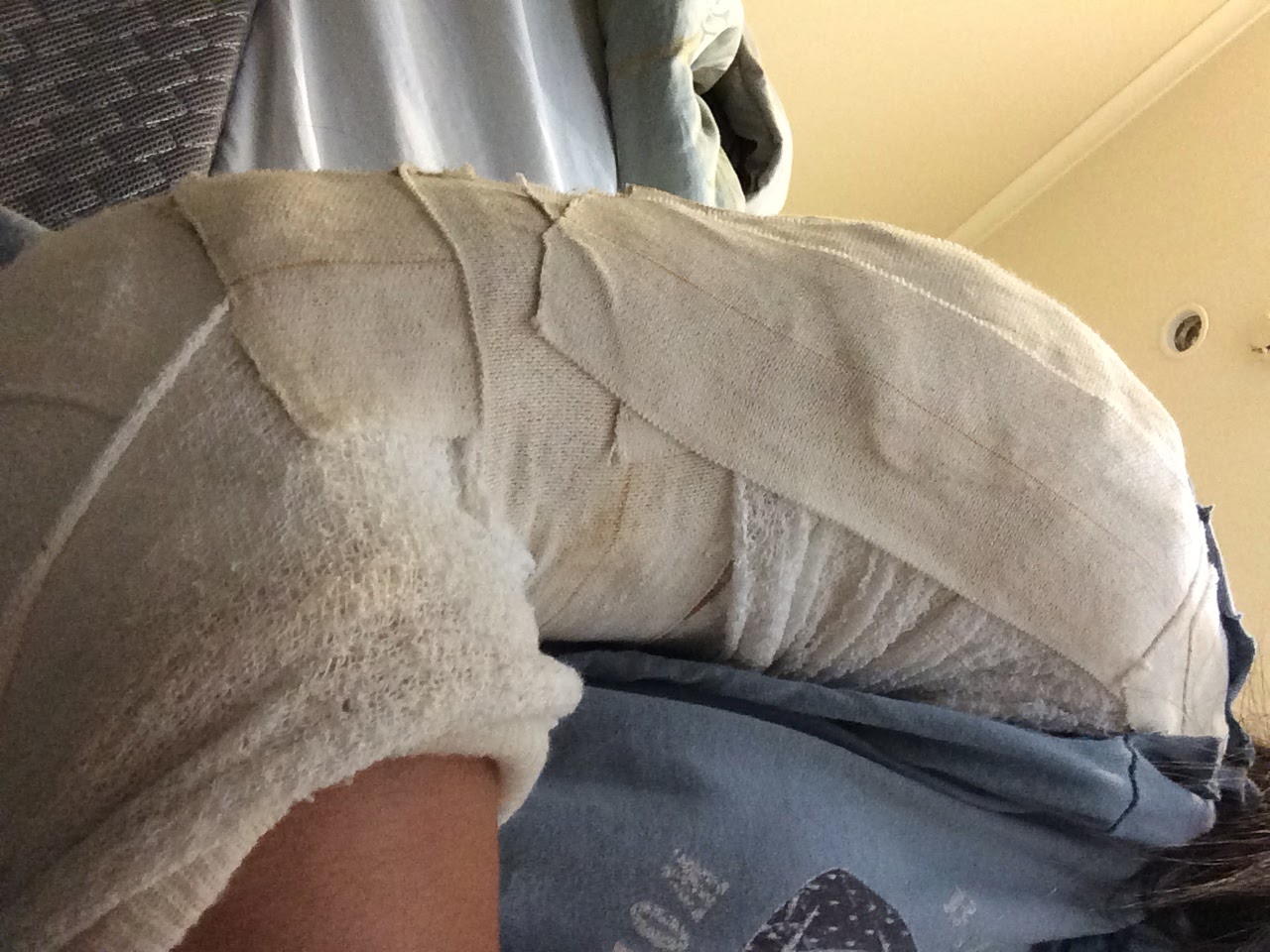 Humerus Break !: Humerus Fracture Week 1 to 2