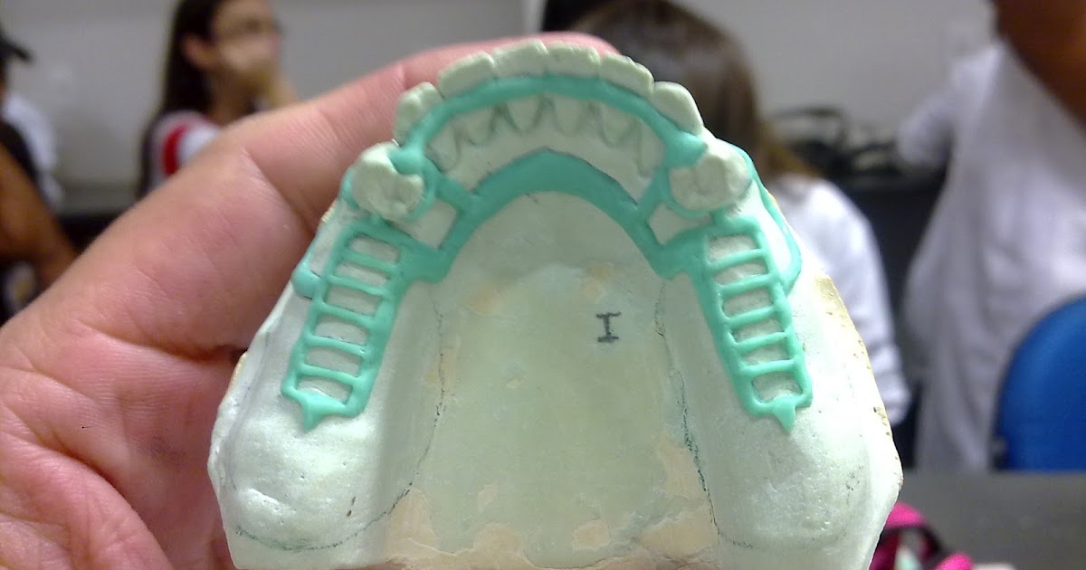 Protese Dentária: PPR - Enceramento de PPR - Fechamento Final - Profº ...