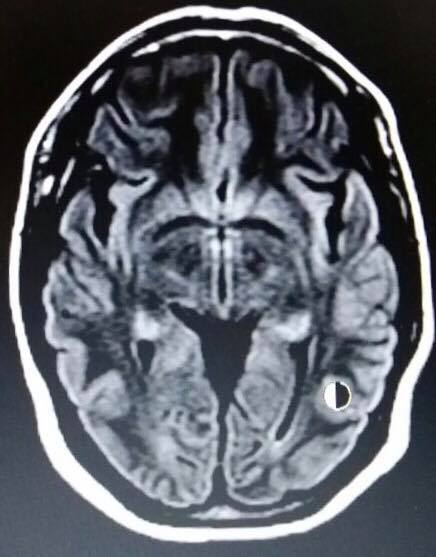 Amyotrophic lateral sclerosis: MRI - Sumer's Radiology Blog
