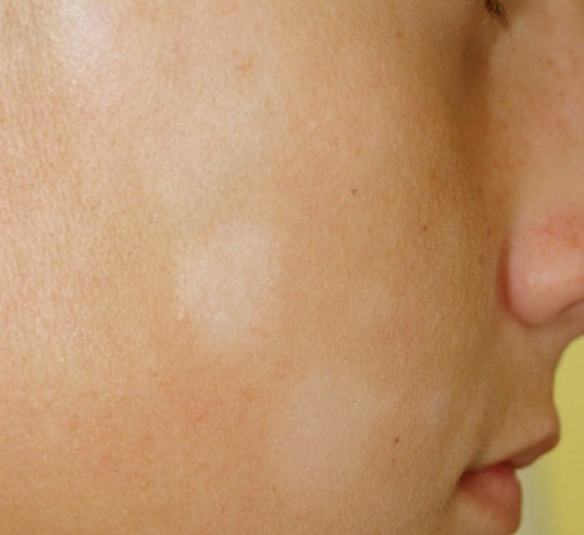 النخالة البيضاء (Pityriasis alba) وعلاجها