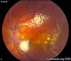 Medical Treatment Pictures-for Better Understanding: Norrie Disease