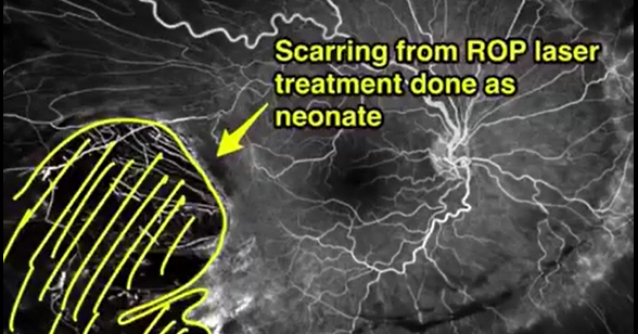 Sequelae of ROP and scarring from ROP in laser treatment done as ...
