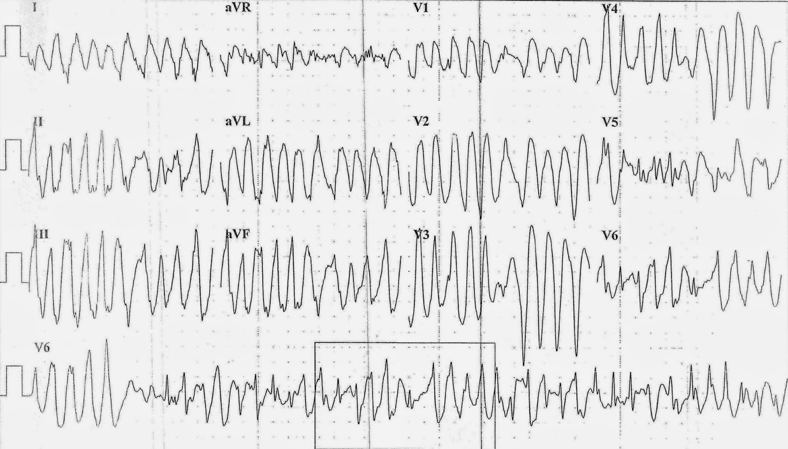 ECG of the Week: ECG of the Week - 16th March 2015