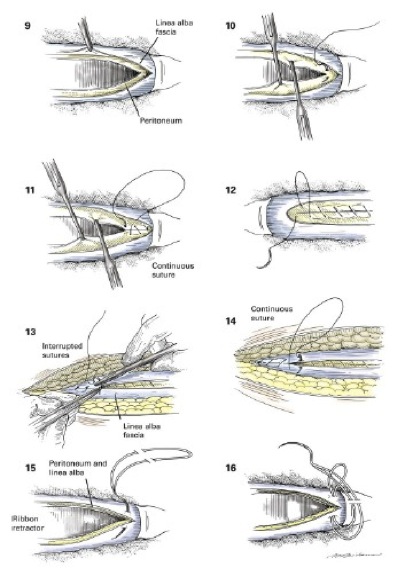 Dr Herry Setya Yudha Utama SpB. FInaCS. MHKes. ICS: LAPAROTOMI
