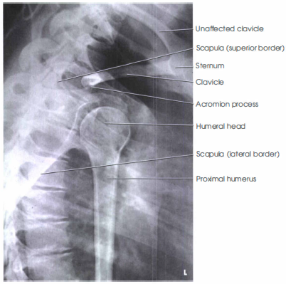 Fracture distal third humerus & Comminuted olecranon fracture. : r ...