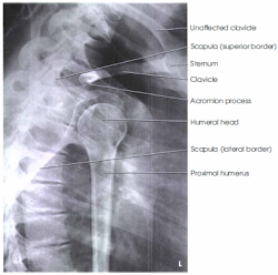 TRANSTHORACIC LATERAL SHOULDER (TRAUMA) - RadTechOnDuty