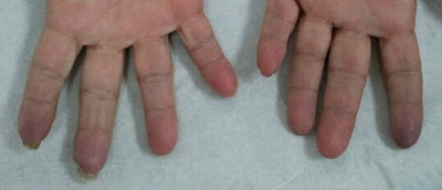 TRABAJAMOS EN MAIRENA: Caso clínico: acrocianosis