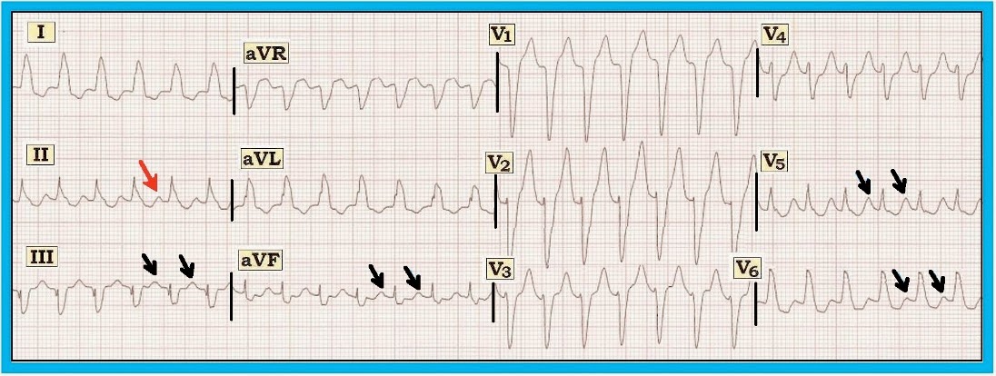 ECG Interpretation: ECG Interpretation Review #41 (WCT - Wide Complex ...