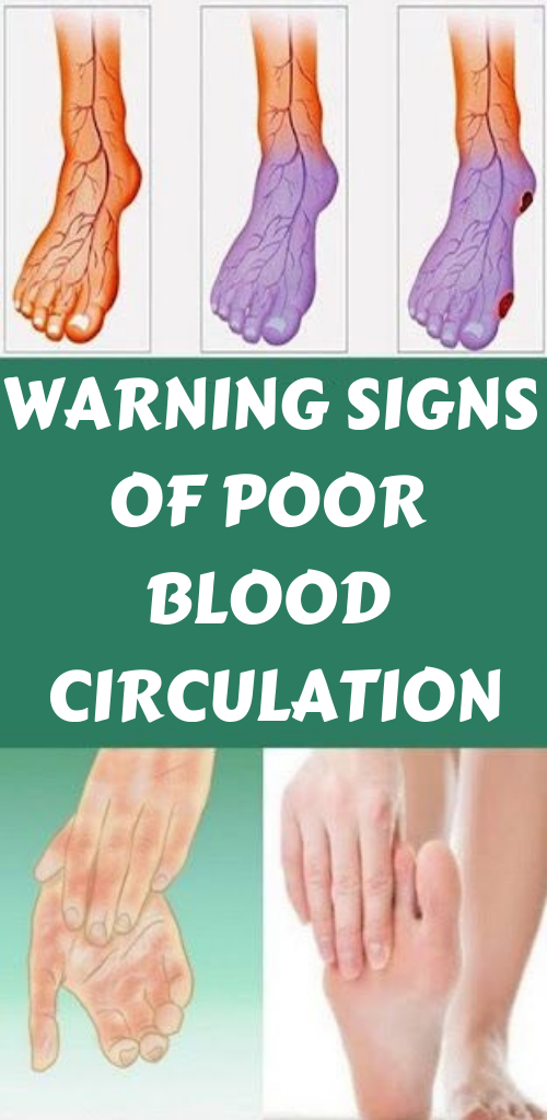 Inspirating Tips About How To Prevent Poor Blood Circulation - Matehope54
