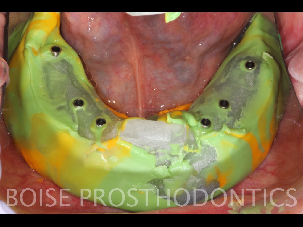 Boise Idaho Prosthodontics: Intra-oral Luting of Implant Verification ...