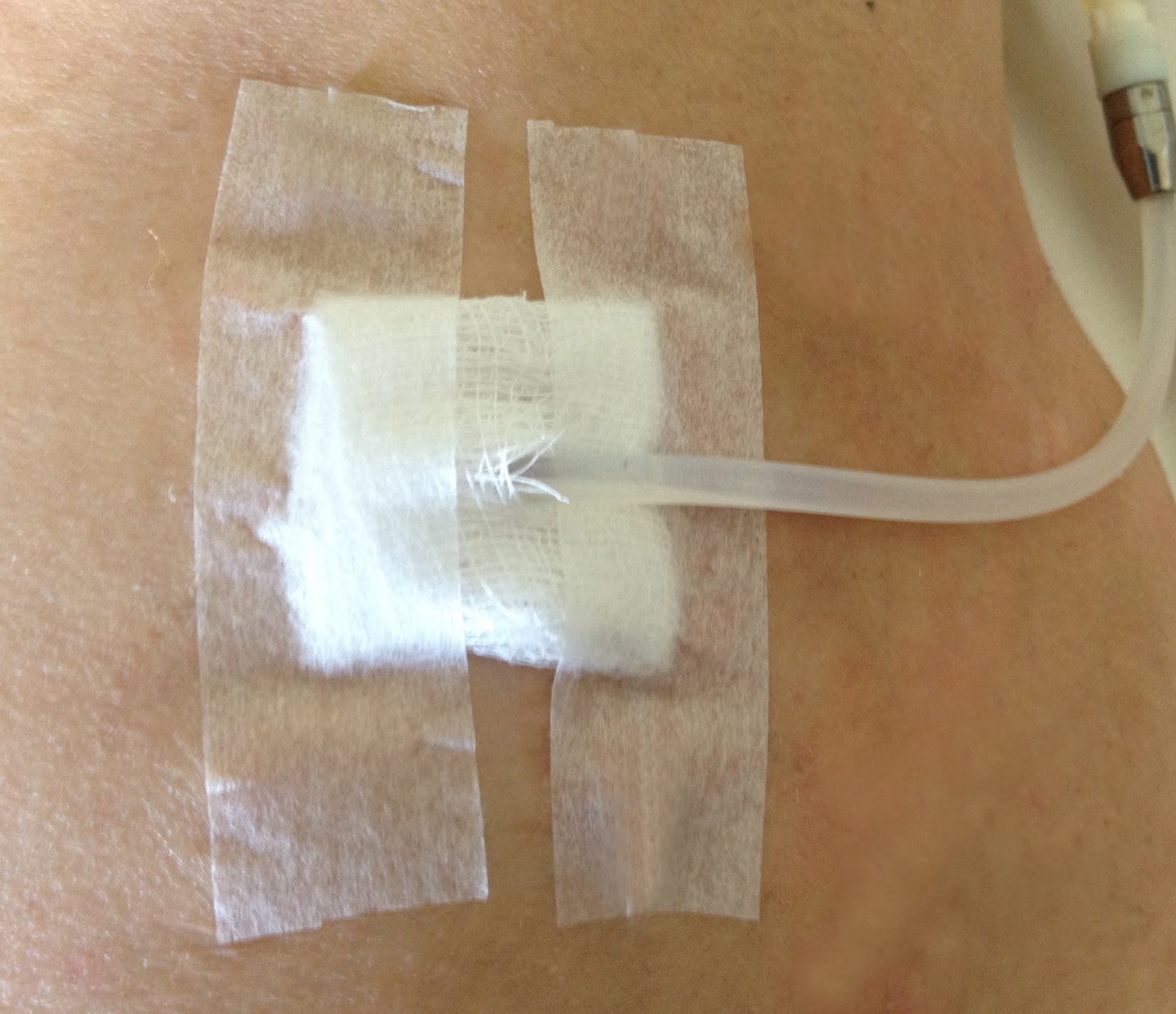 Convivendo com o cateter