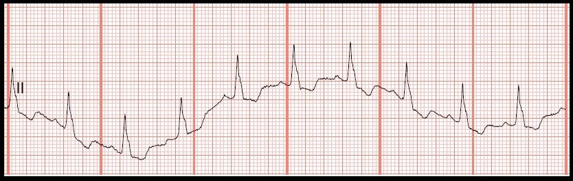 EKG Rhythm Strip Quiz 177