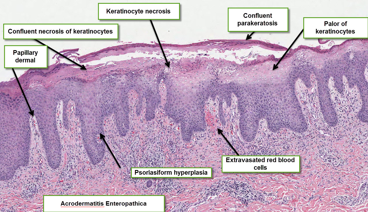 Dermatopathology Made Simple - Inflammatory: Epidermal changes because ...