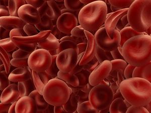 Drépanocytose définition , causes et symptômes - FSSM - SVTU Cours , TD ...