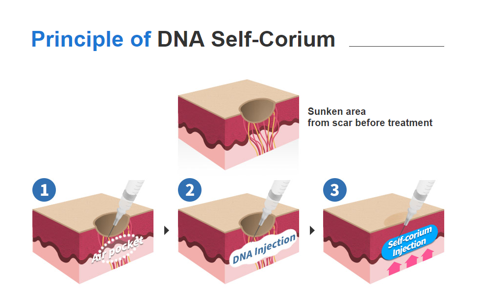 Renewme Skin Clinic: New techniques:DNA Self-Corium for depressed scar ...
